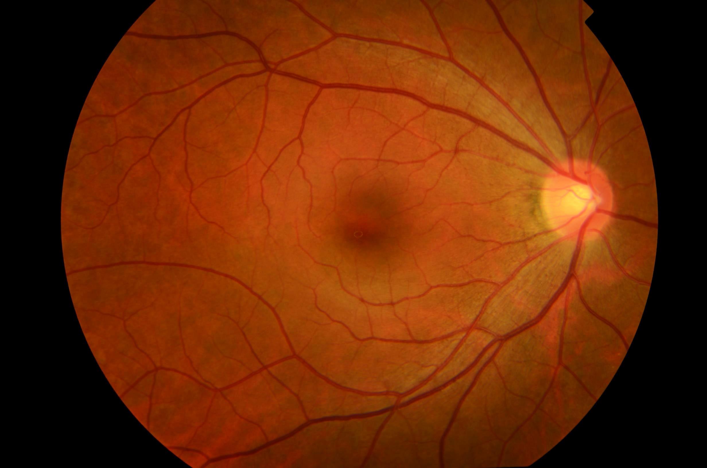 Development journey of Singapore eye screening AI system published as ...